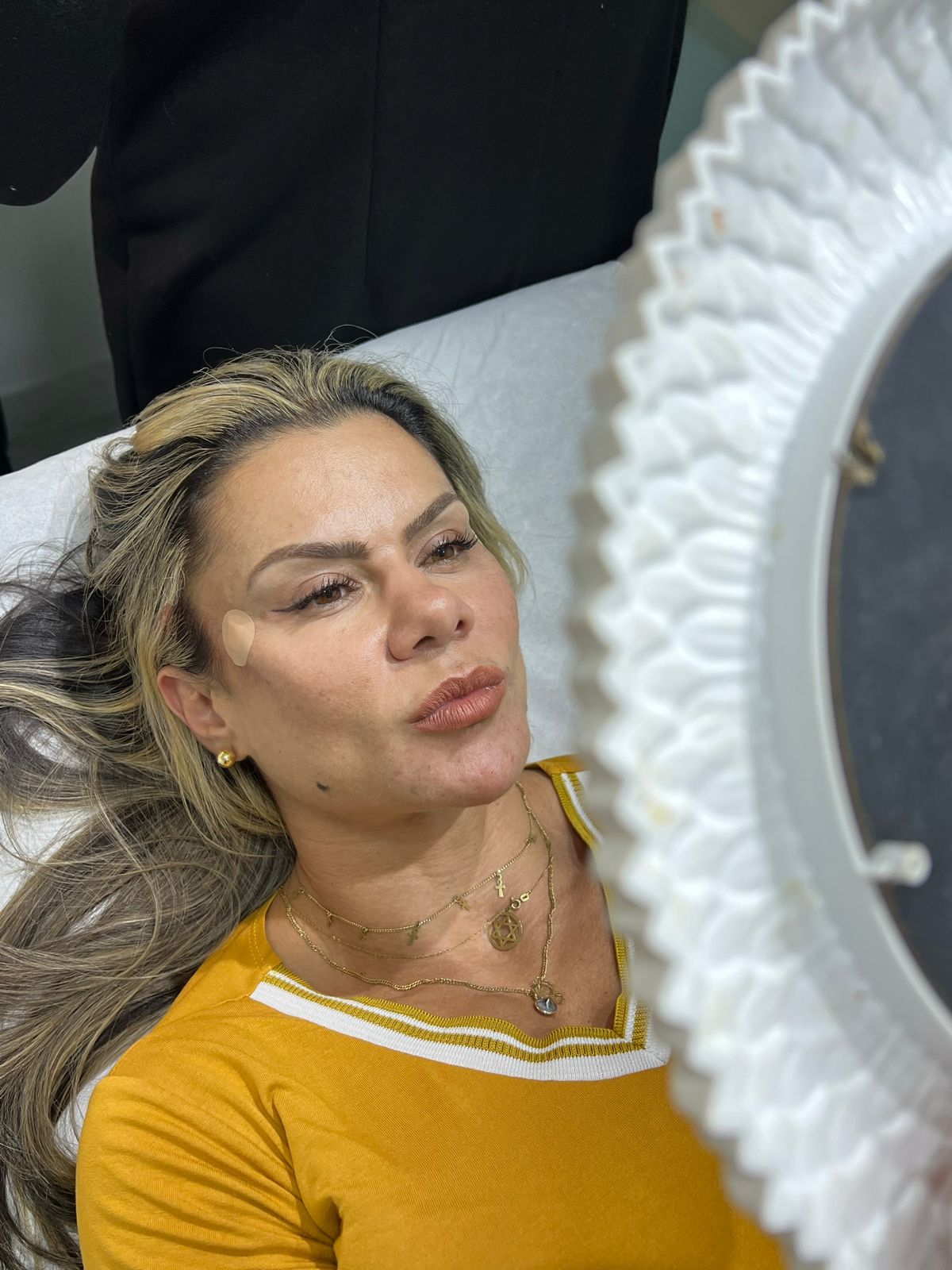 PMMA corrige perda de volume e melhora a estética facial - Biossimetric®