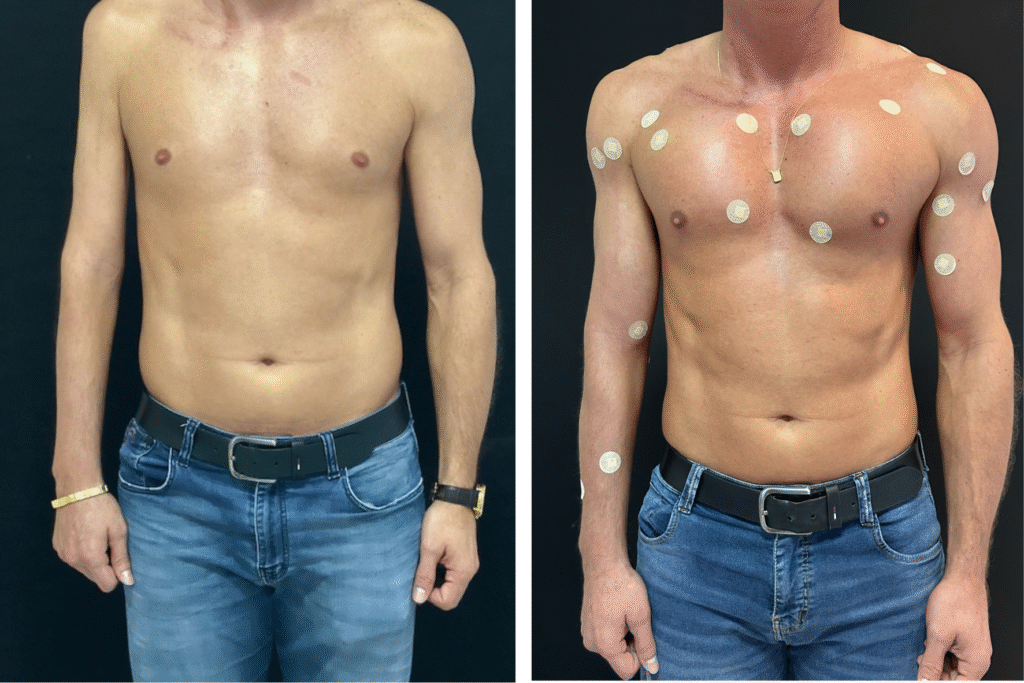 Estudo revela como PMMA corrige sequela de acidente de moto e promove o ...